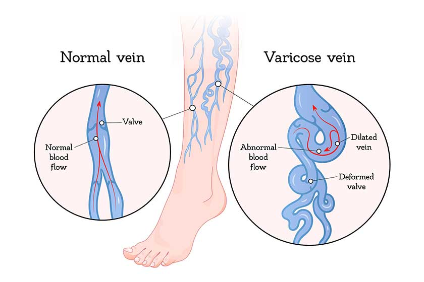 4 Causes Of Varicose Veins | TerraBella