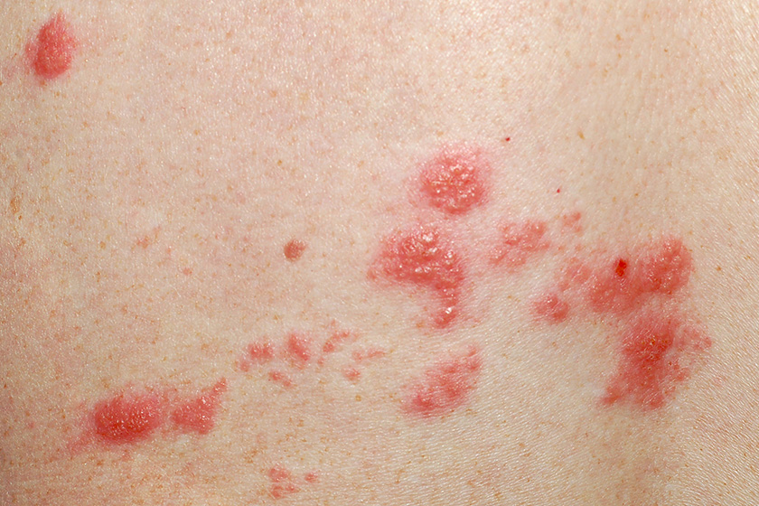 Managing Shingles: How Assisted Senior Care In Lawrenceville, GA ...
