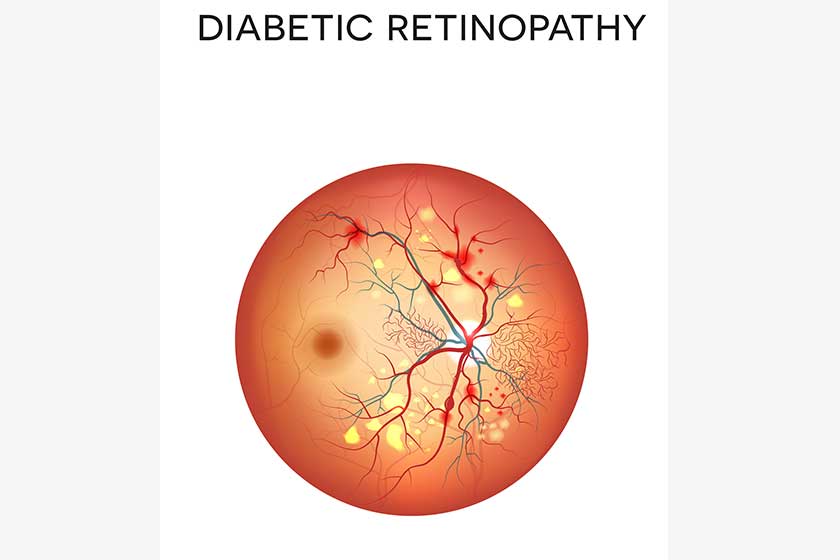 7 Symptoms Of Diabetic Retinopathy That Seniors Shouldn't Ignore ...